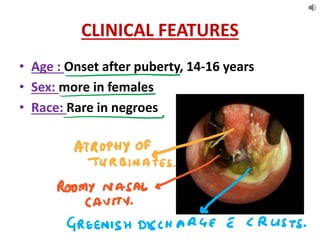 Atrophic rhinitis.pptx