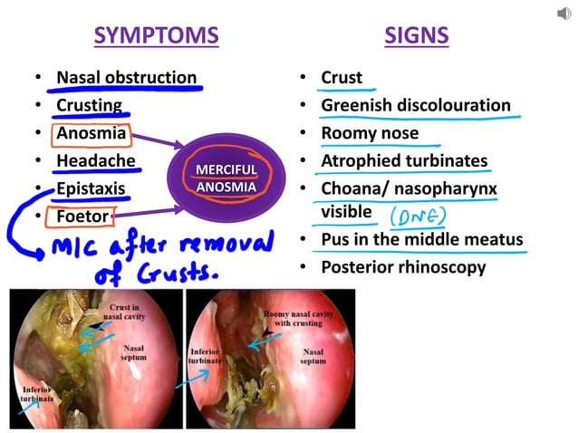 Atrophic rhinitis.pptx