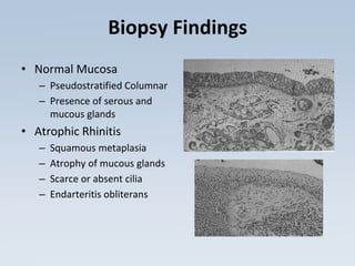 Atrophic Rhinitis.pptx
