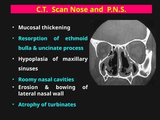 Atrophic rhinitis.ppt for MBBS STUDENTS YEAR 3 MINOR SUBJECT | PPT