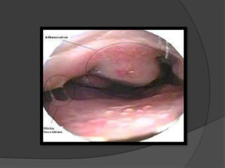 Atrophic rhinitis and Allergic rhinitis-ENT 3rd MBBS | PPTX