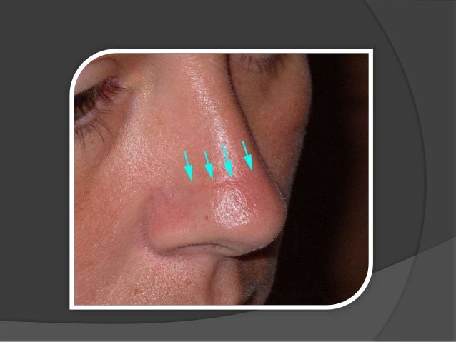 What disease is associated with transverse nasal crease? : r/Step2