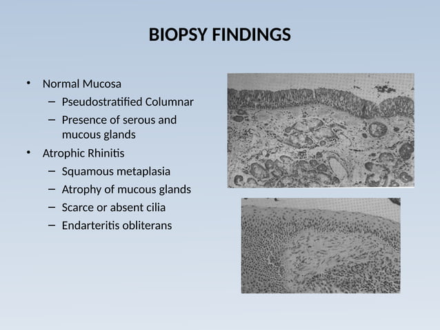 Atrophic Rhinitis and its management.pptx