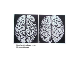 Atrophy | PPTX