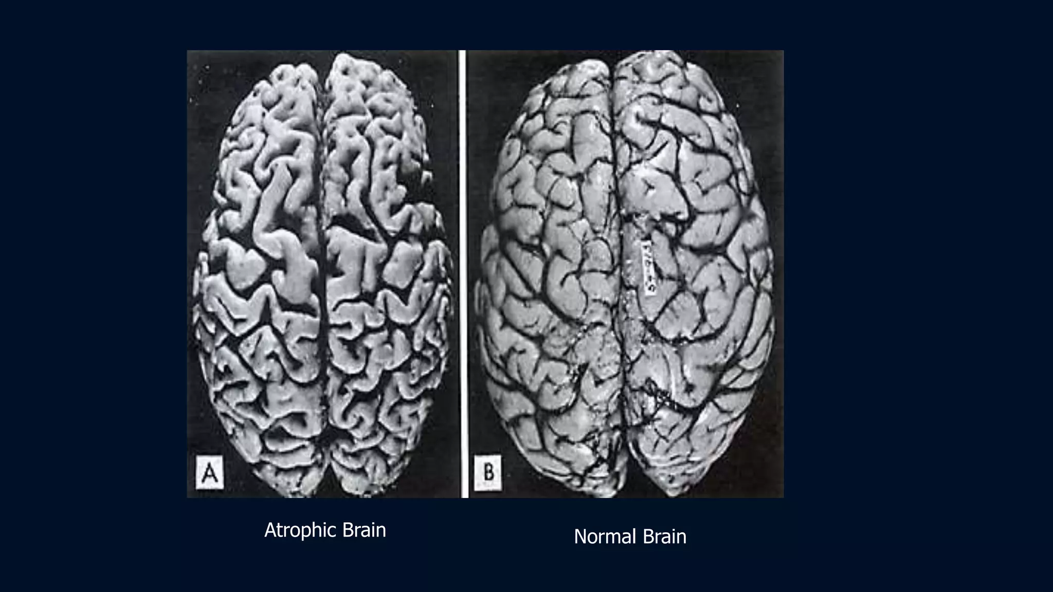 Atrophy | PPTX