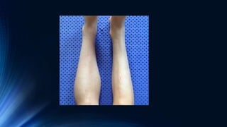 Atrophy | PPTX