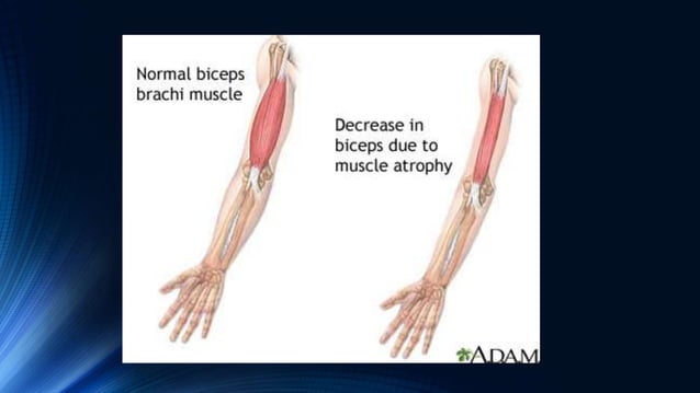 Atrophy | PPTX