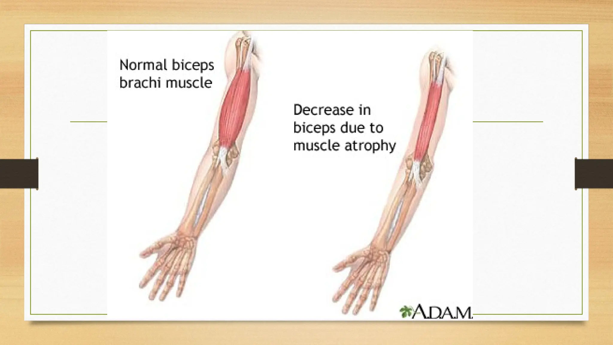 atrophy65856475646543643643543543643654.pptx