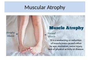 atrophy is a disorder of muscle shrinking. | PPT