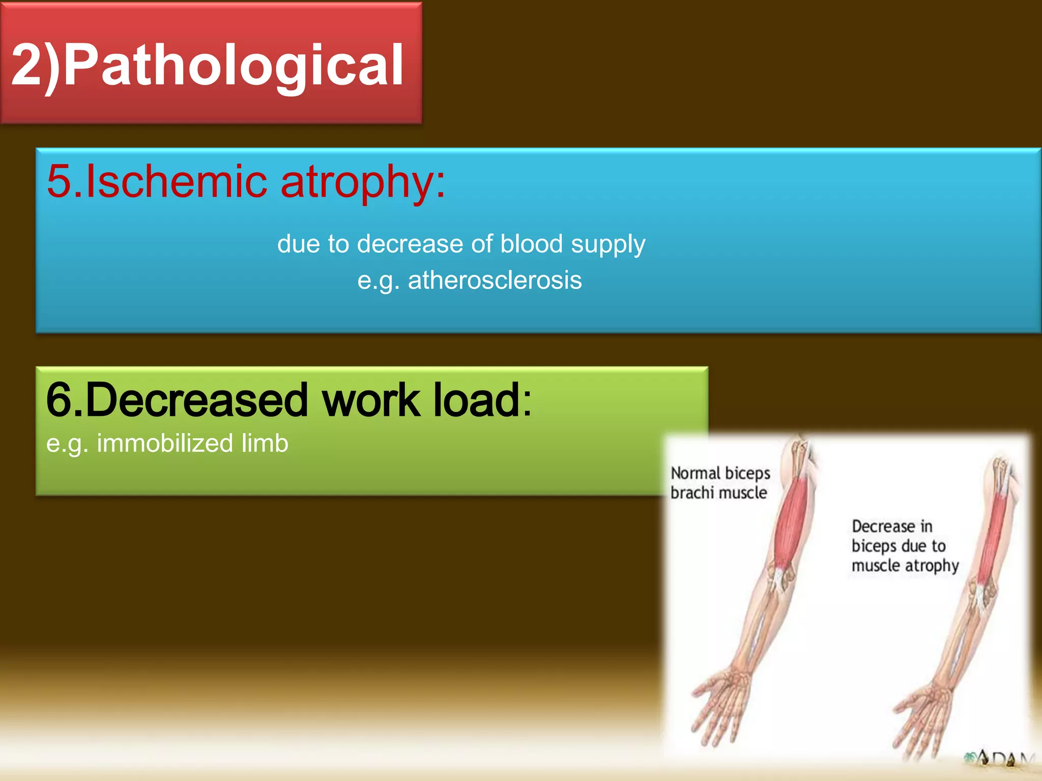 Atrophy | PDF