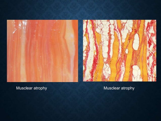 Atrophy and dystrophy-accumulation.ppt