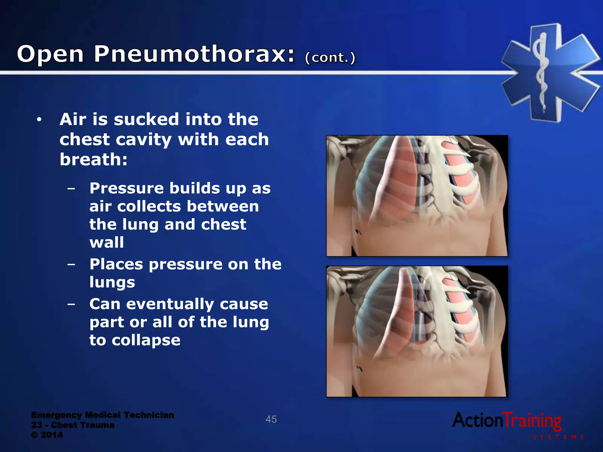 ATS - chest trauma | PPT