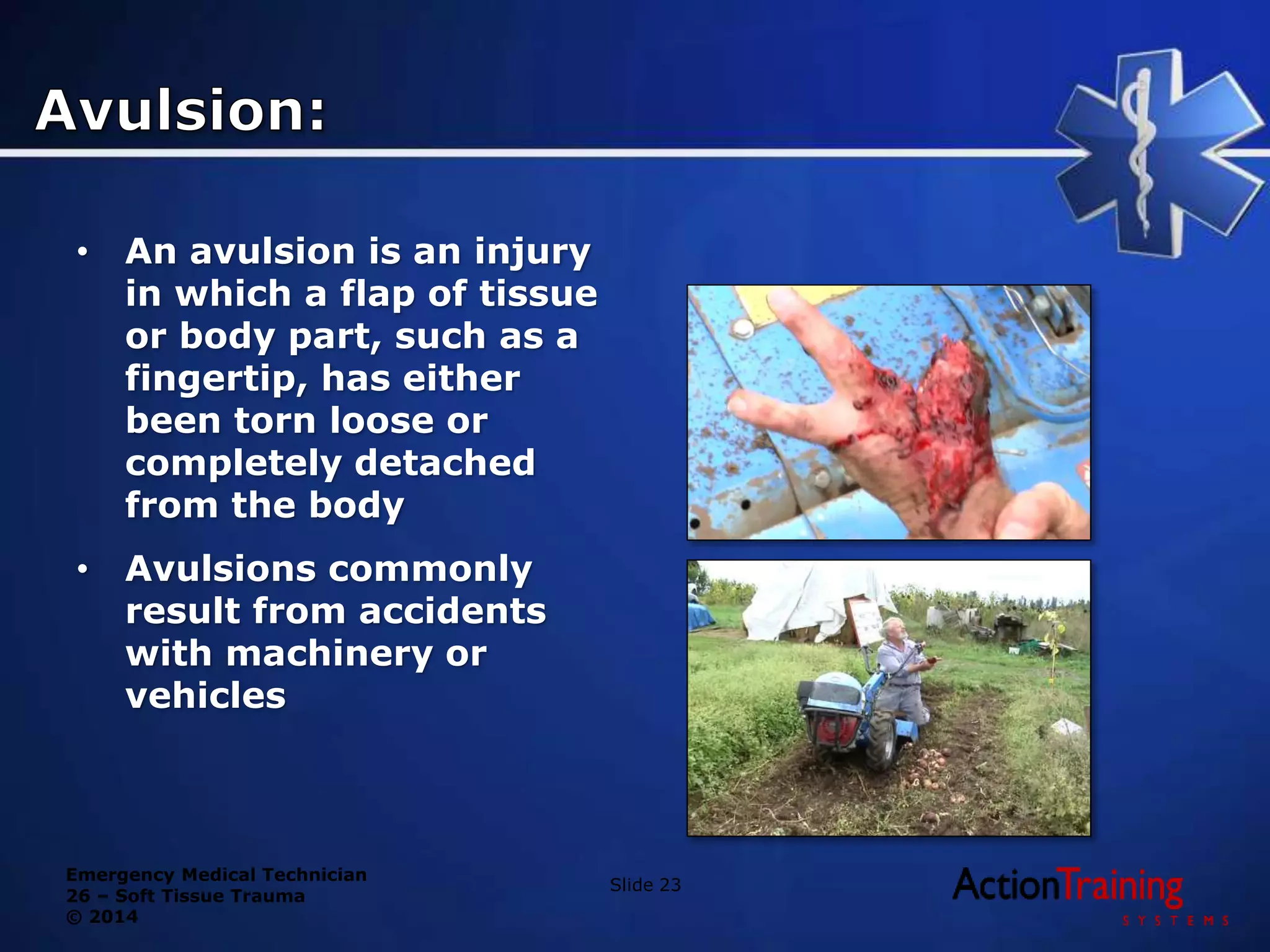 ATS - soft tissue trauma | PPTX