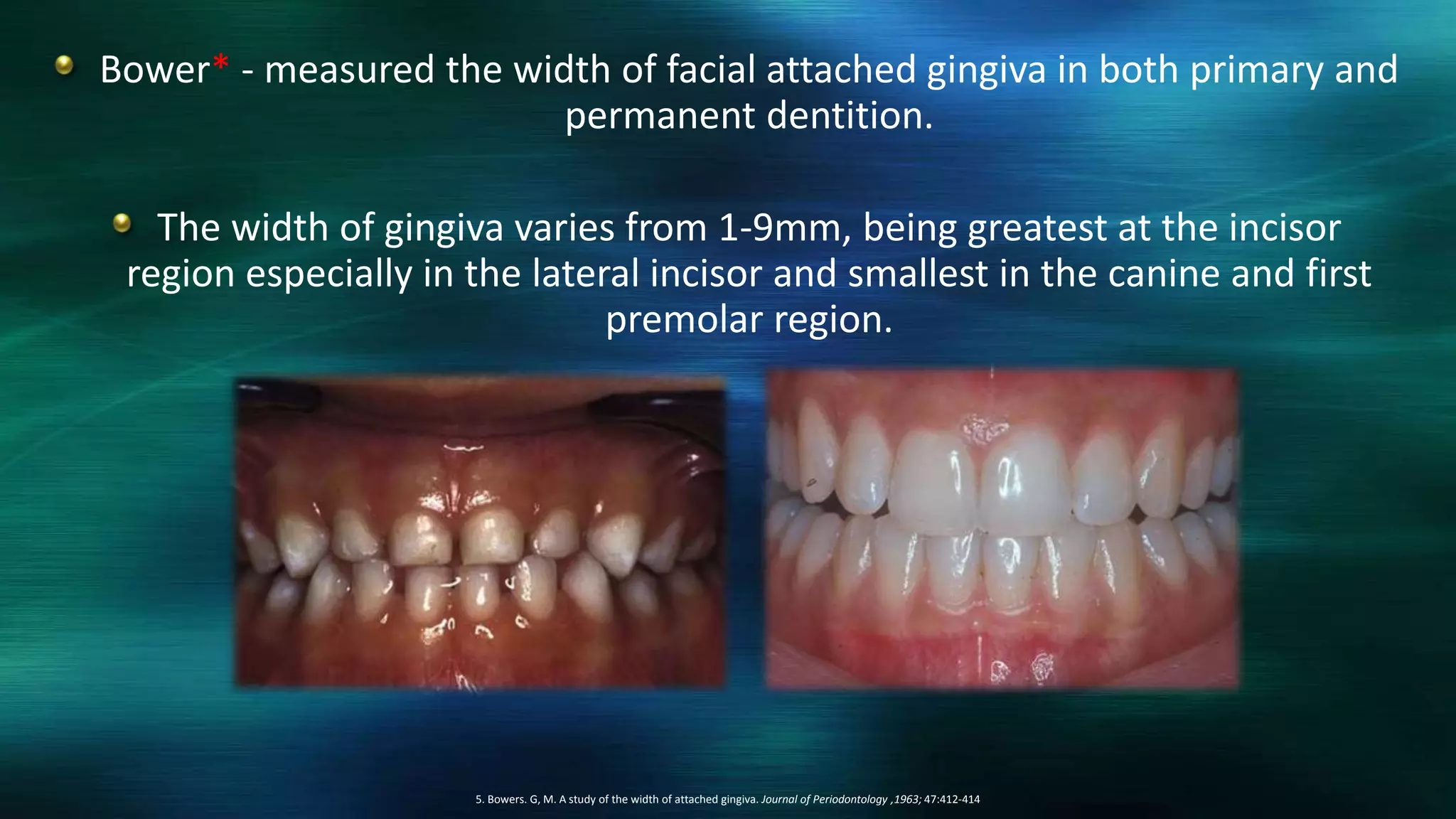 Attached gingiva and its significance | PPTX
