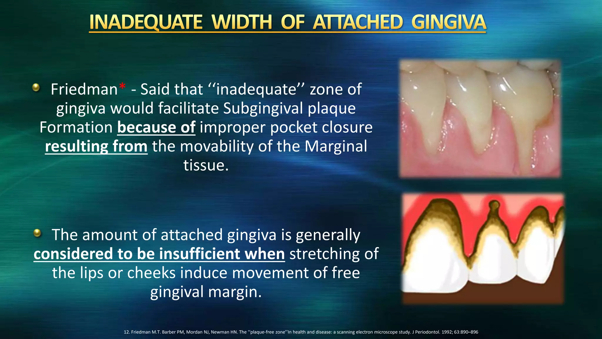 Attached gingiva and its significance | PPTX