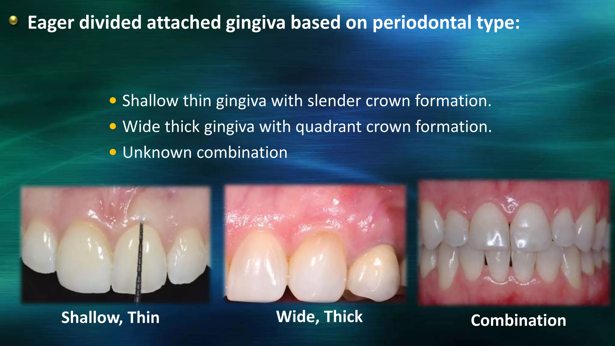 Attached gingiva and its significance | PPTX