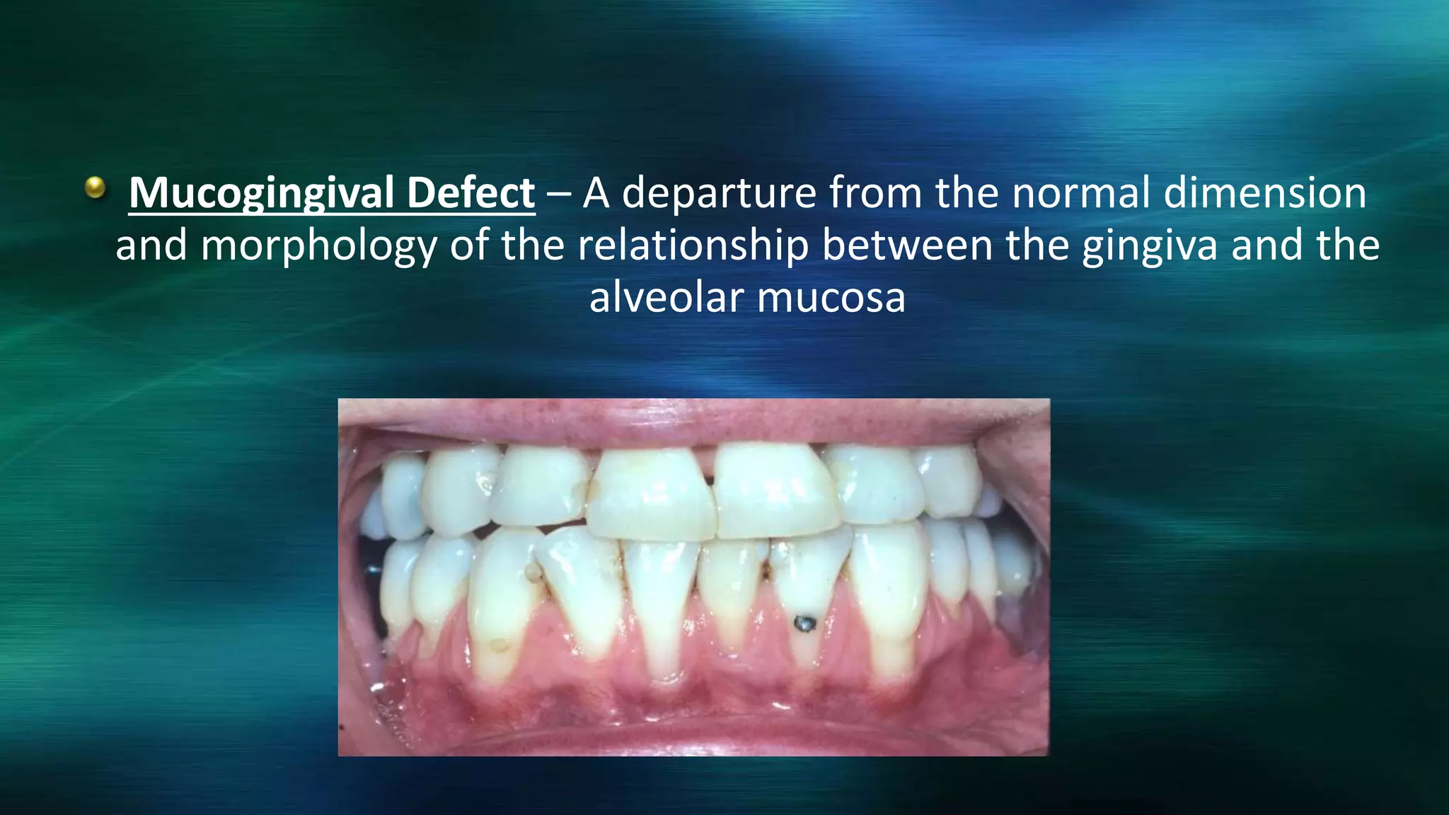Attached gingiva and its significance | PPTX