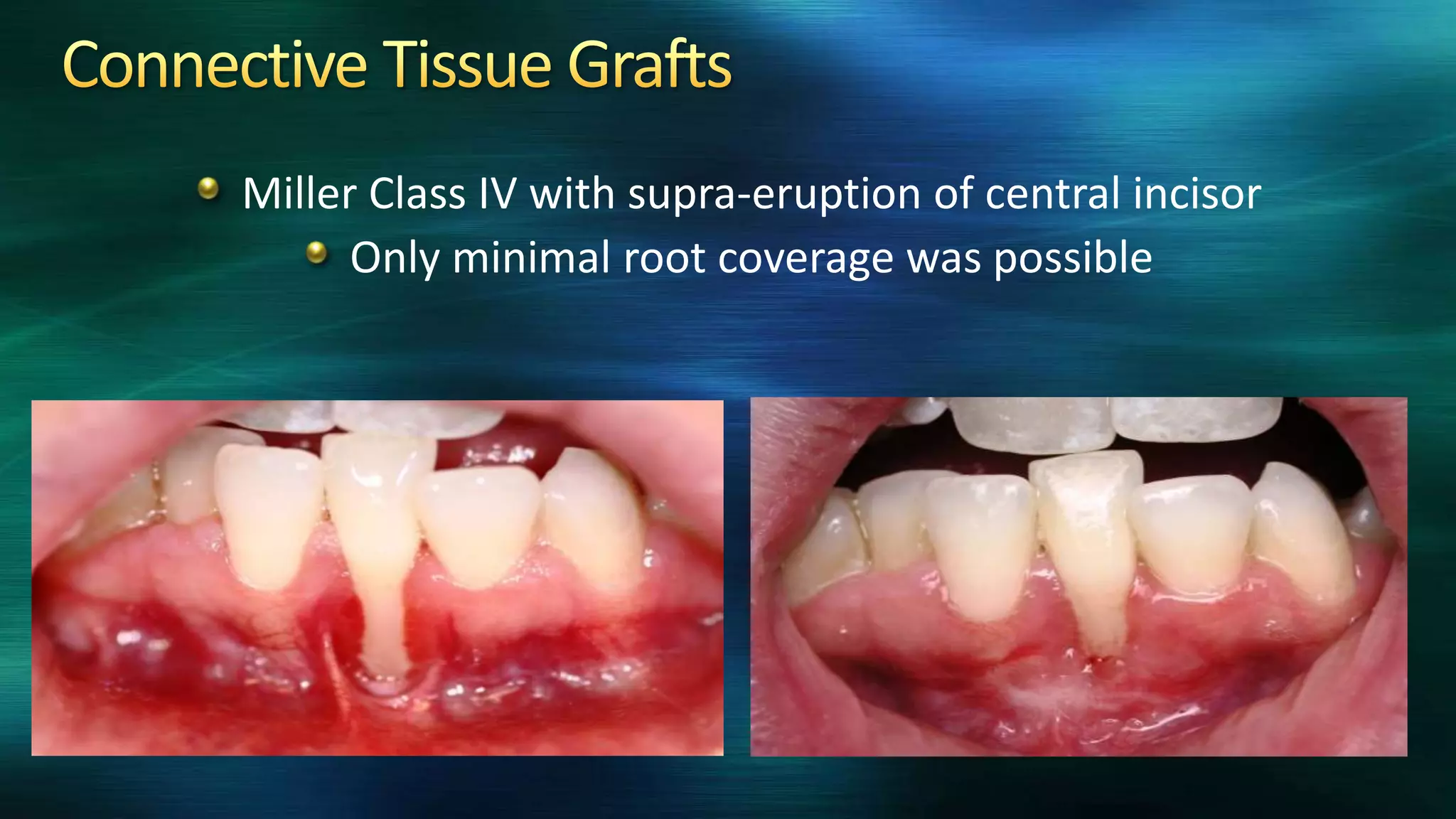 Attached gingiva and its significance | PPTX