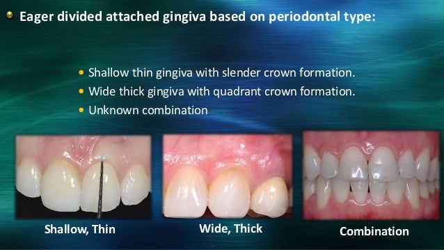 Attached gingiva and its significance