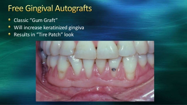 Attached gingiva and its significance