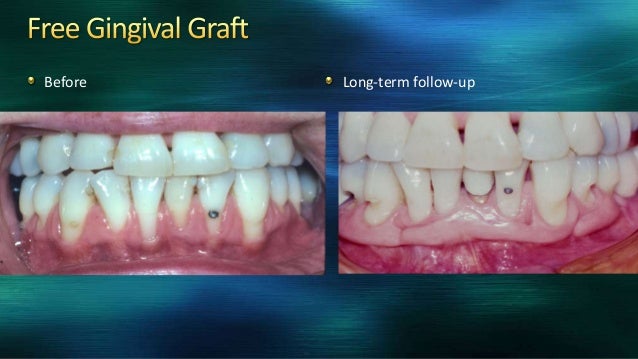 Attached gingiva and its significance