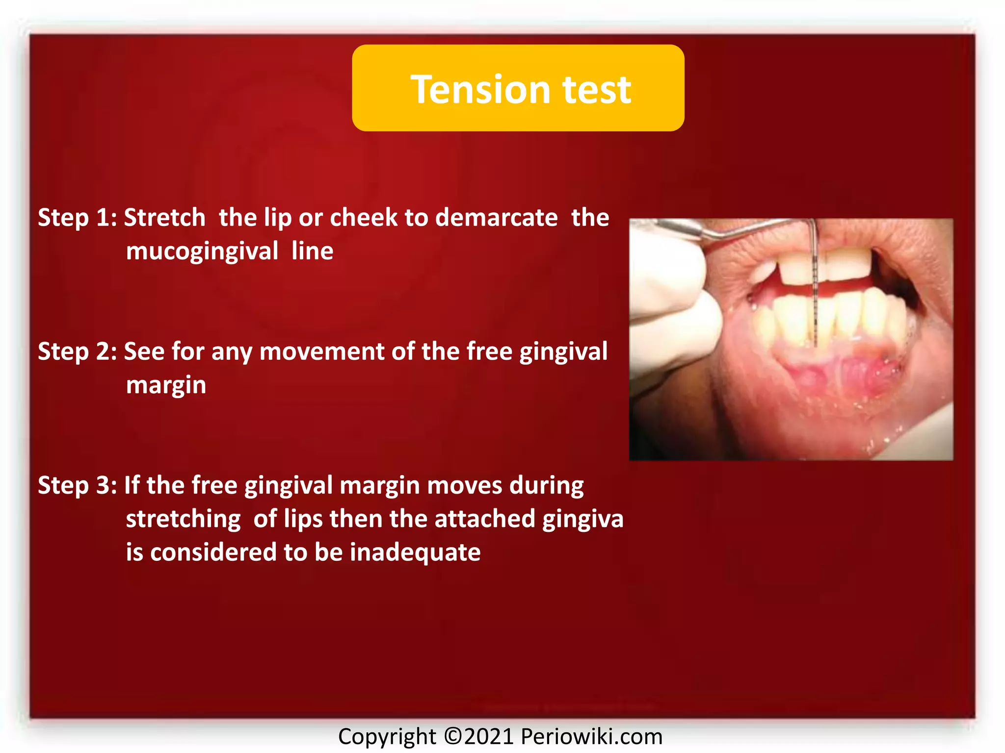 Attached gingiva and procedures for gingival augmentation | PPTX