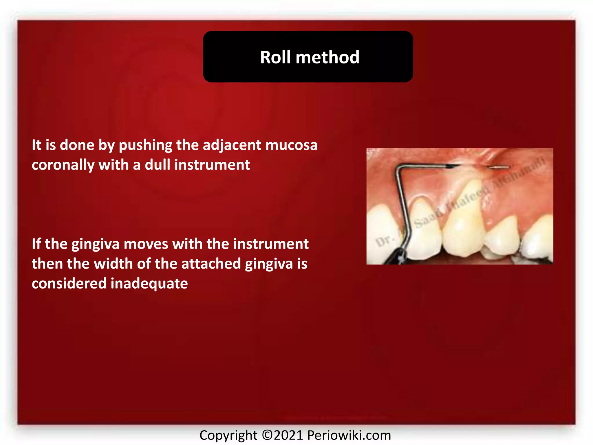Attached gingiva and procedures for gingival augmentation | PPTX