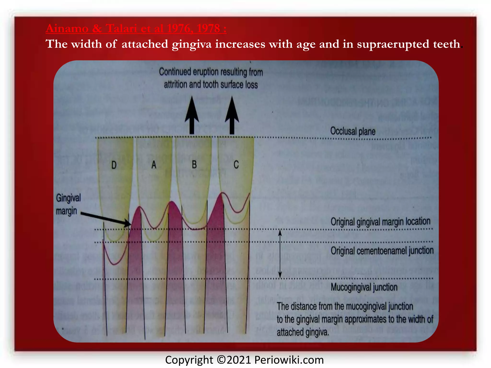 Attached gingiva and procedures for gingival augmentation | PPTX | Oral ...