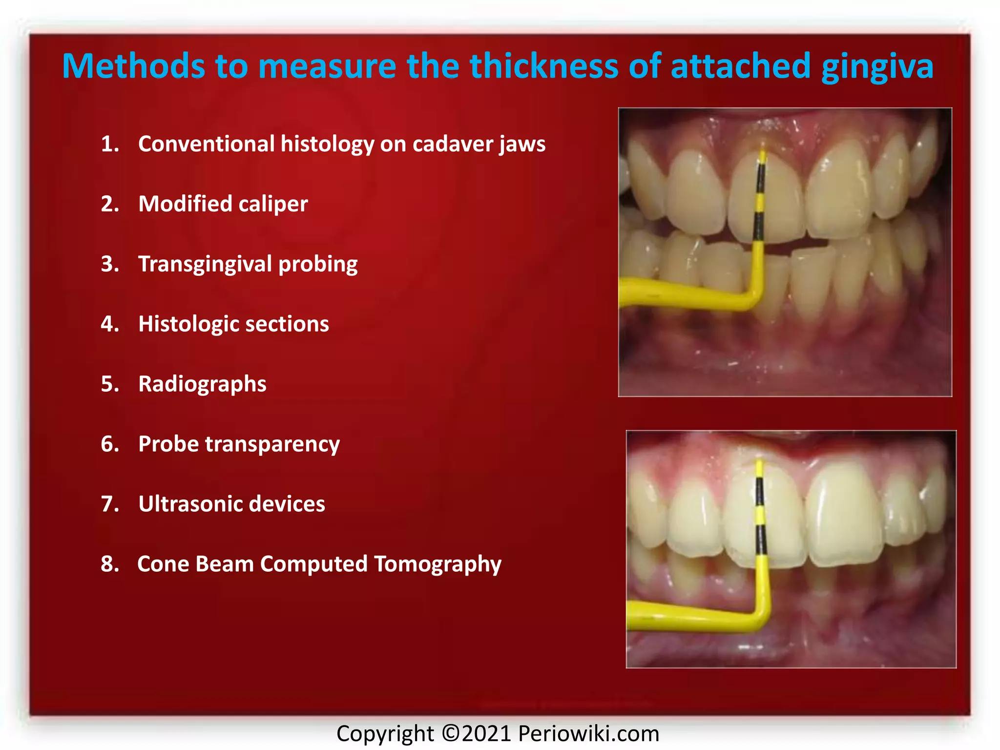 Attached gingiva and procedures for gingival augmentation | PPTX | Oral ...