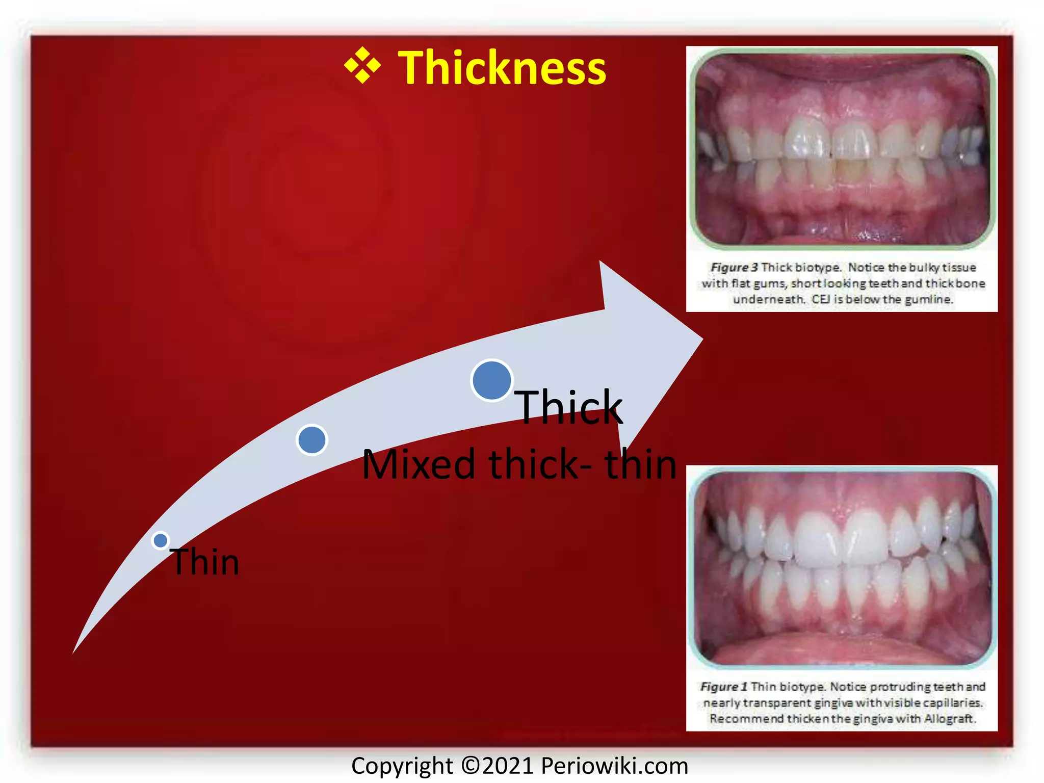 Attached gingiva and procedures for gingival augmentation | PPTX