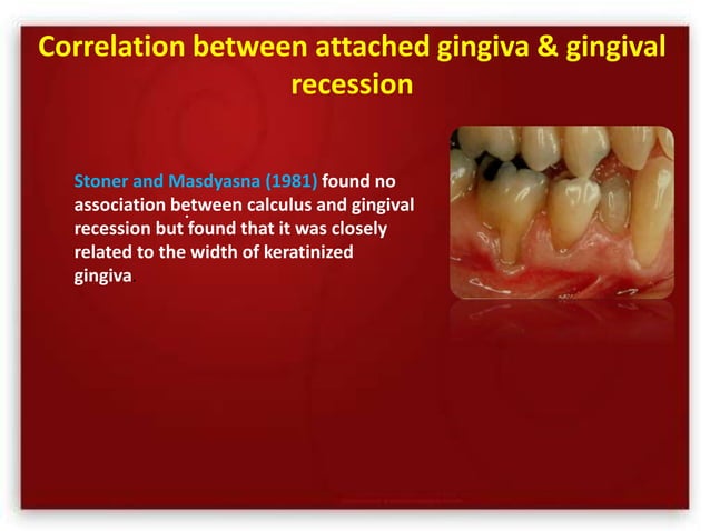 Attached gingiva and procedures for gingival augmentation | PPTX | Oral care | Personal Care