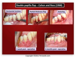 Attached gingiva and procedures for gingival augmentation | PPTX