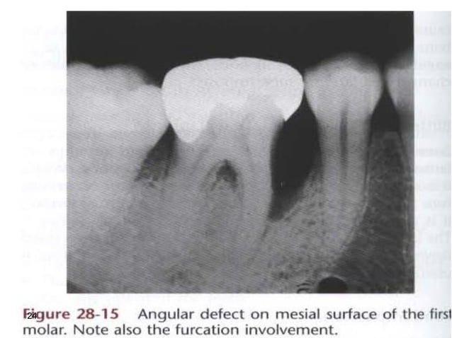 perio lec3 bone loss | PDF