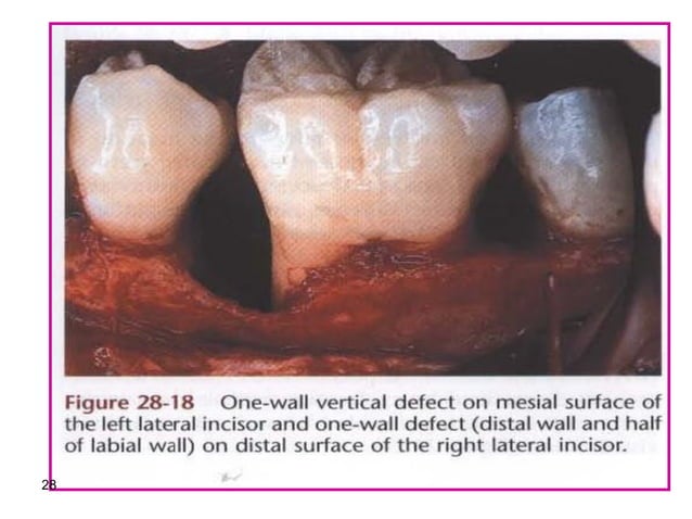 perio lec3 bone loss | PDF