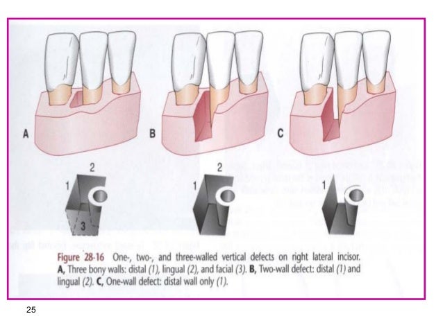 perio lec3 bone loss