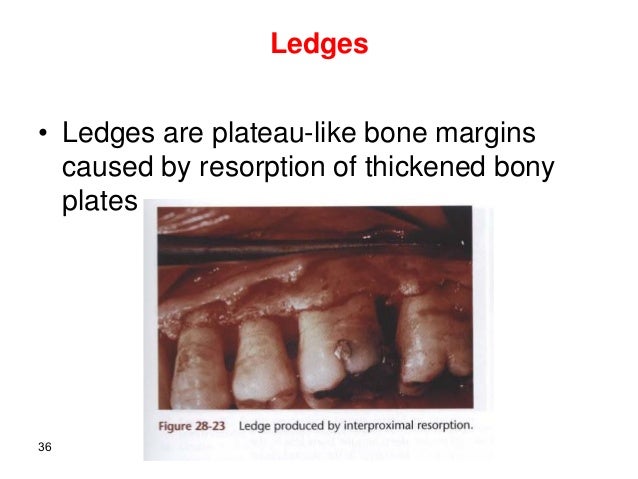 perio lec3 bone loss