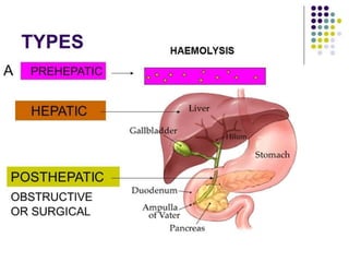 Obstructive jaundice | PPTX
