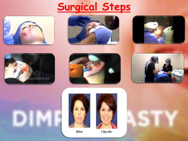 DIMPLEPLASTY | PPTX | Cosmetic Medical Services | Medical Health