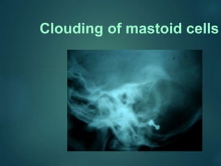 Mastoid Air Cells X Ray