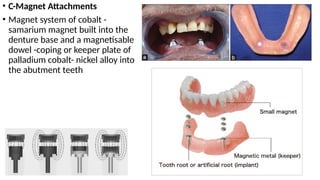 ATTACHMENTUSED IN COMPLETE DENTURE IN DENTISTRY.pptx