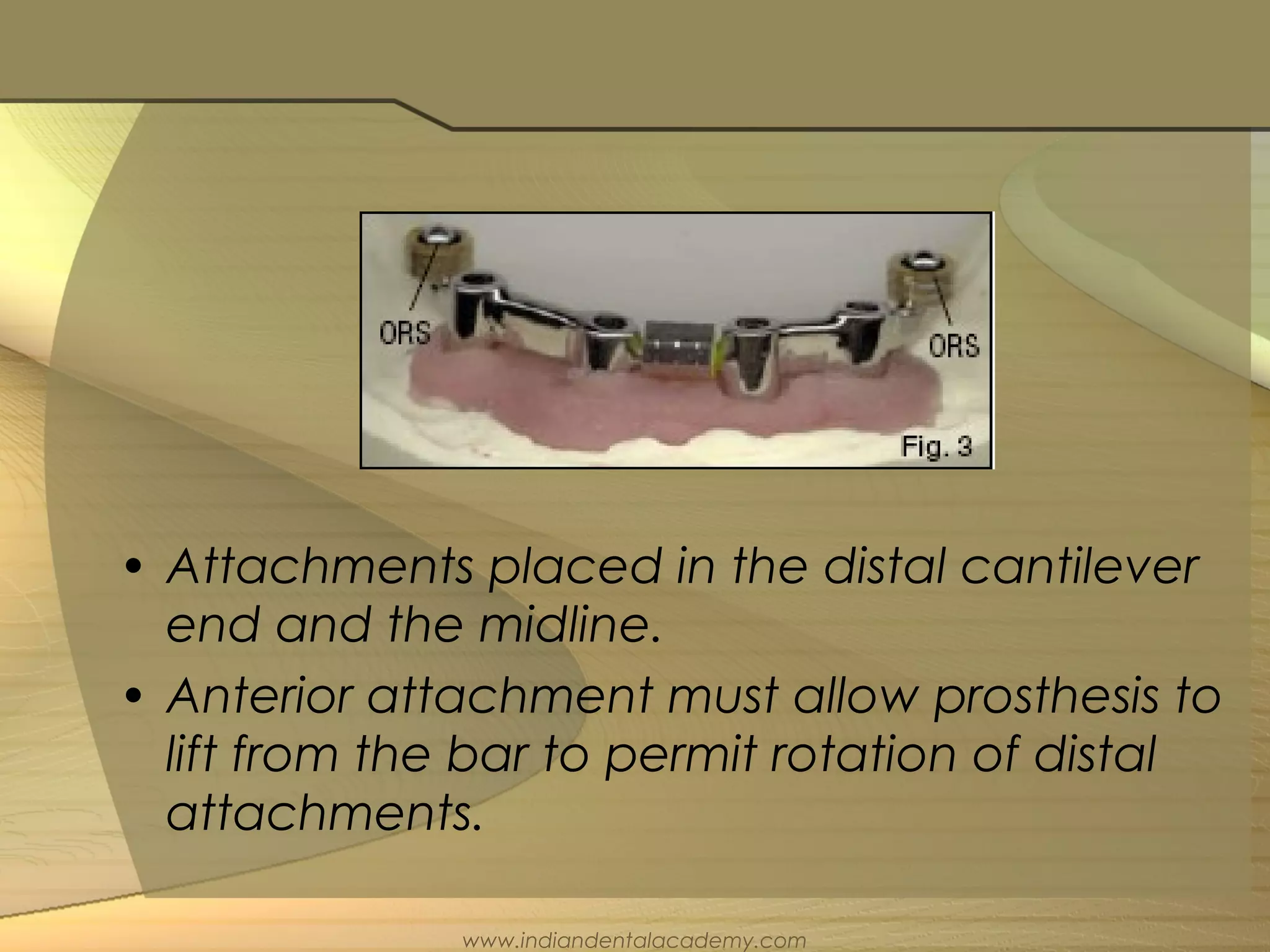 Attachments in implant retained overdentures/ cosmetic dentistry ...