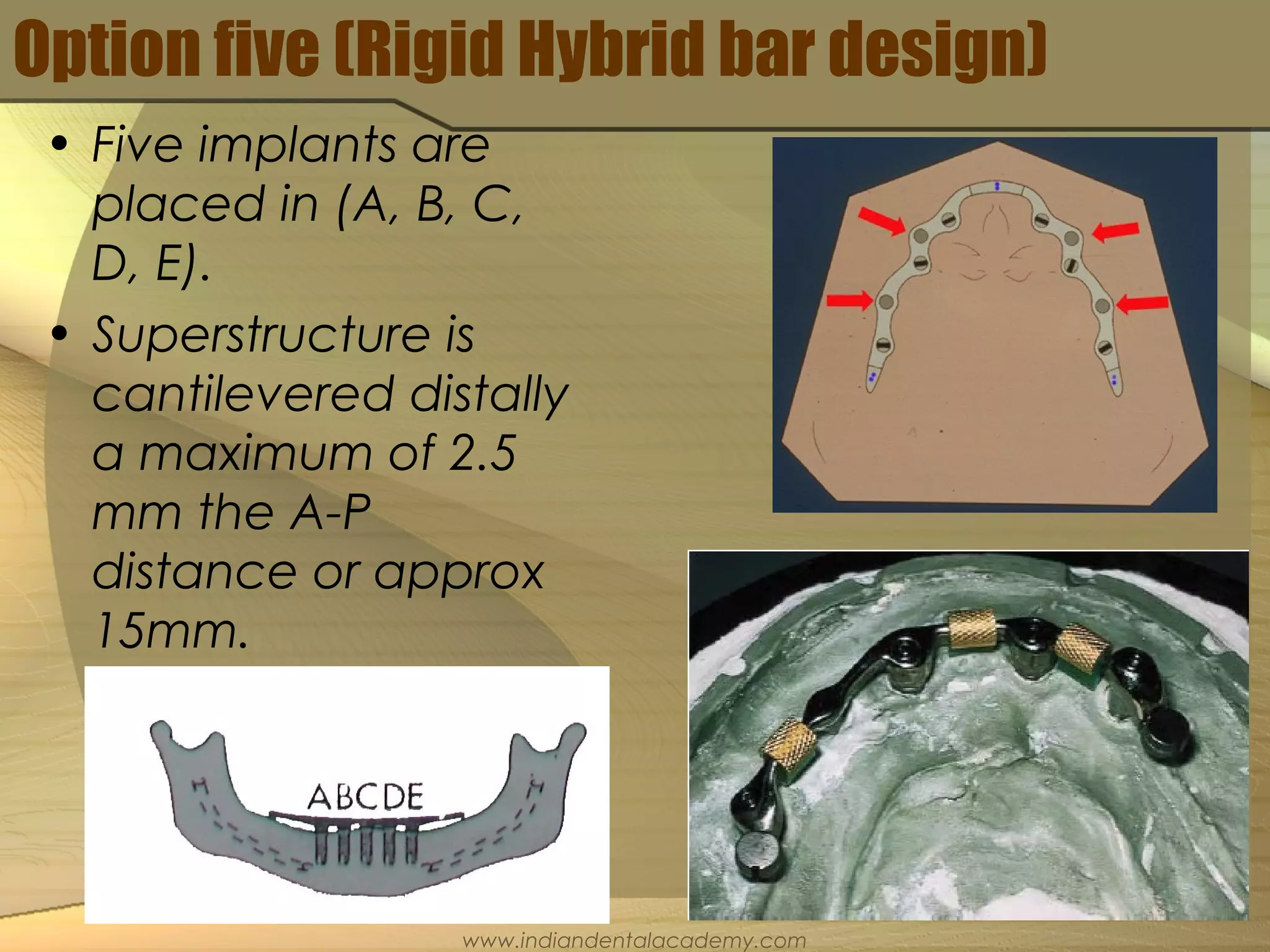 Attachments in implant retained overdentures/ cosmetic dentistry ...