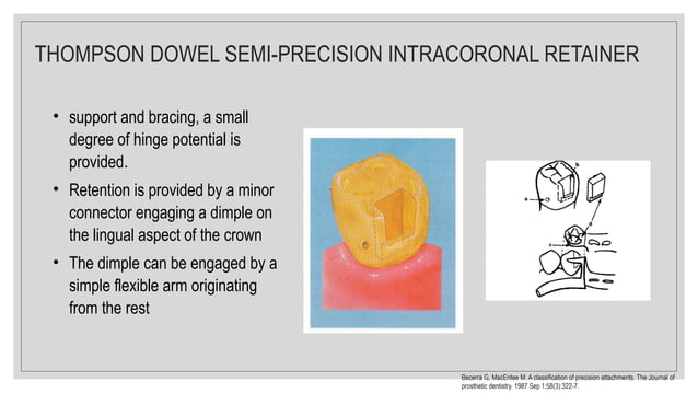 ATTACHMENTS IN RPD.pptx MFS dentistry …// | PPTX