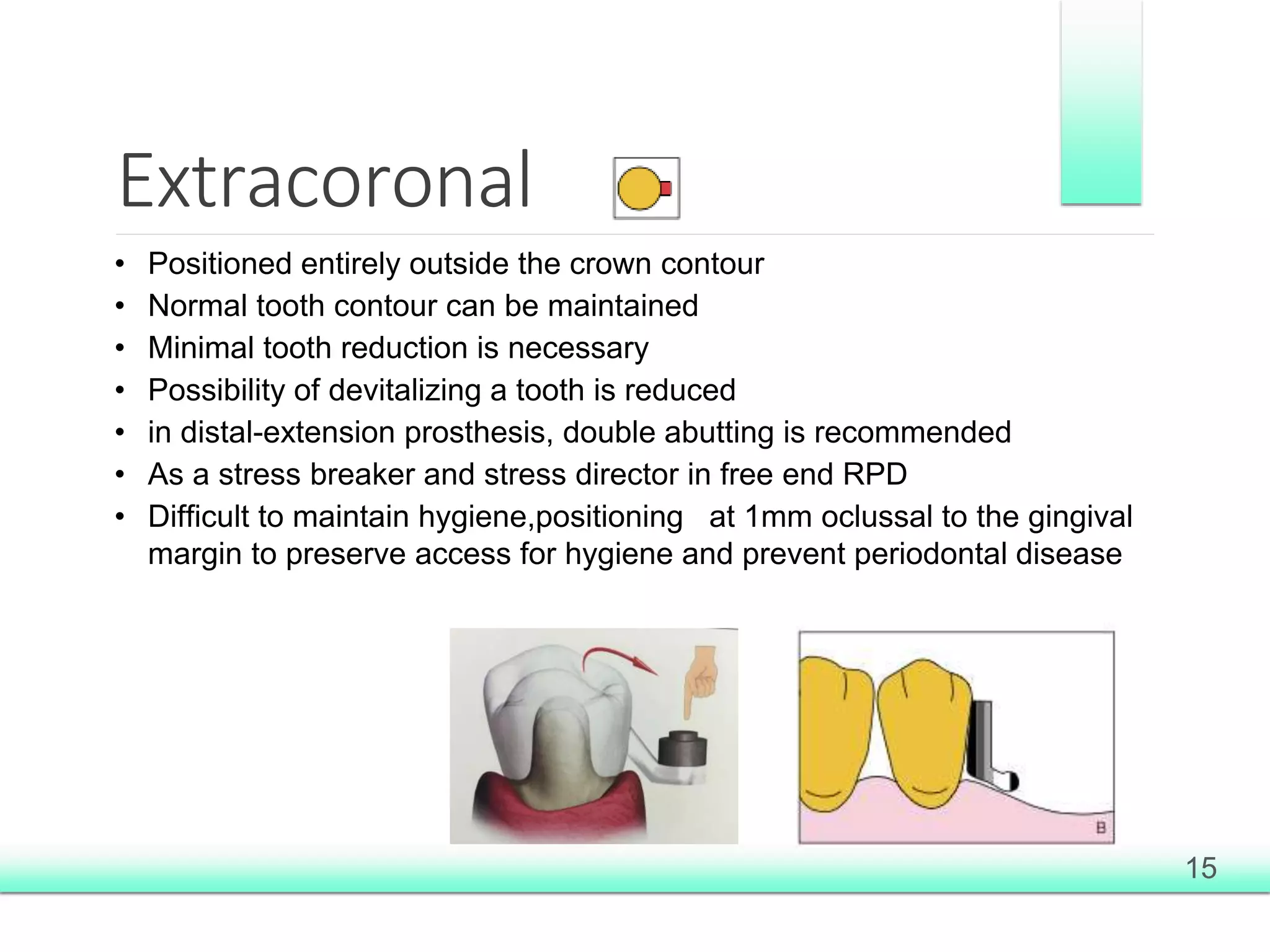 Attachments in removable partial prosthesis | PPTX