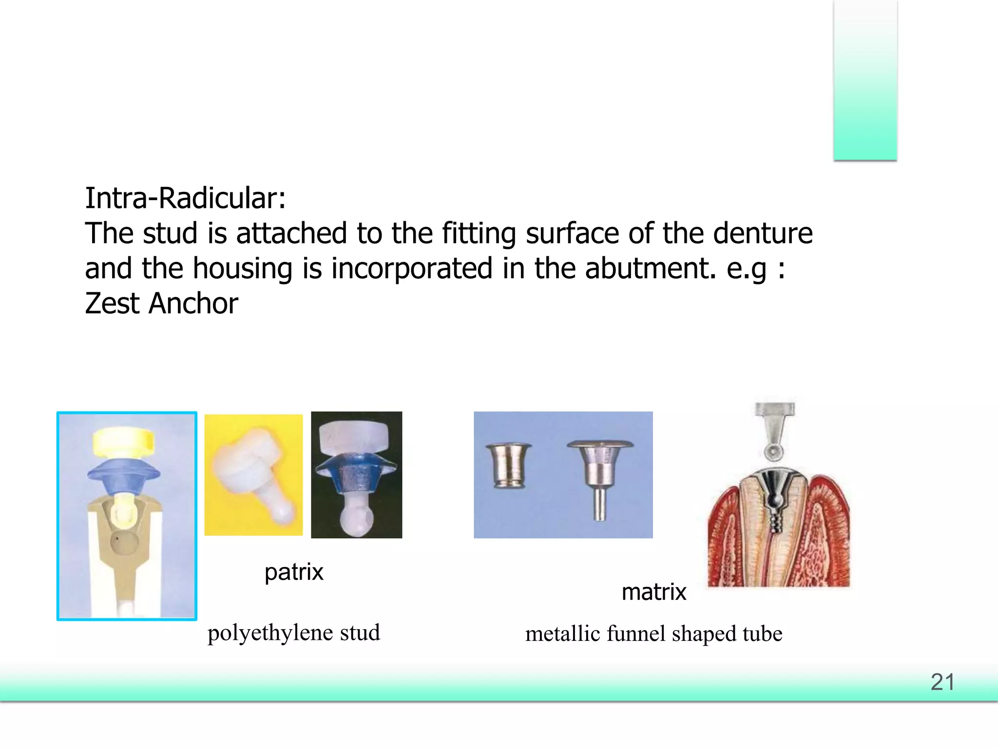 Attachments in removable partial prosthesis | PPTX