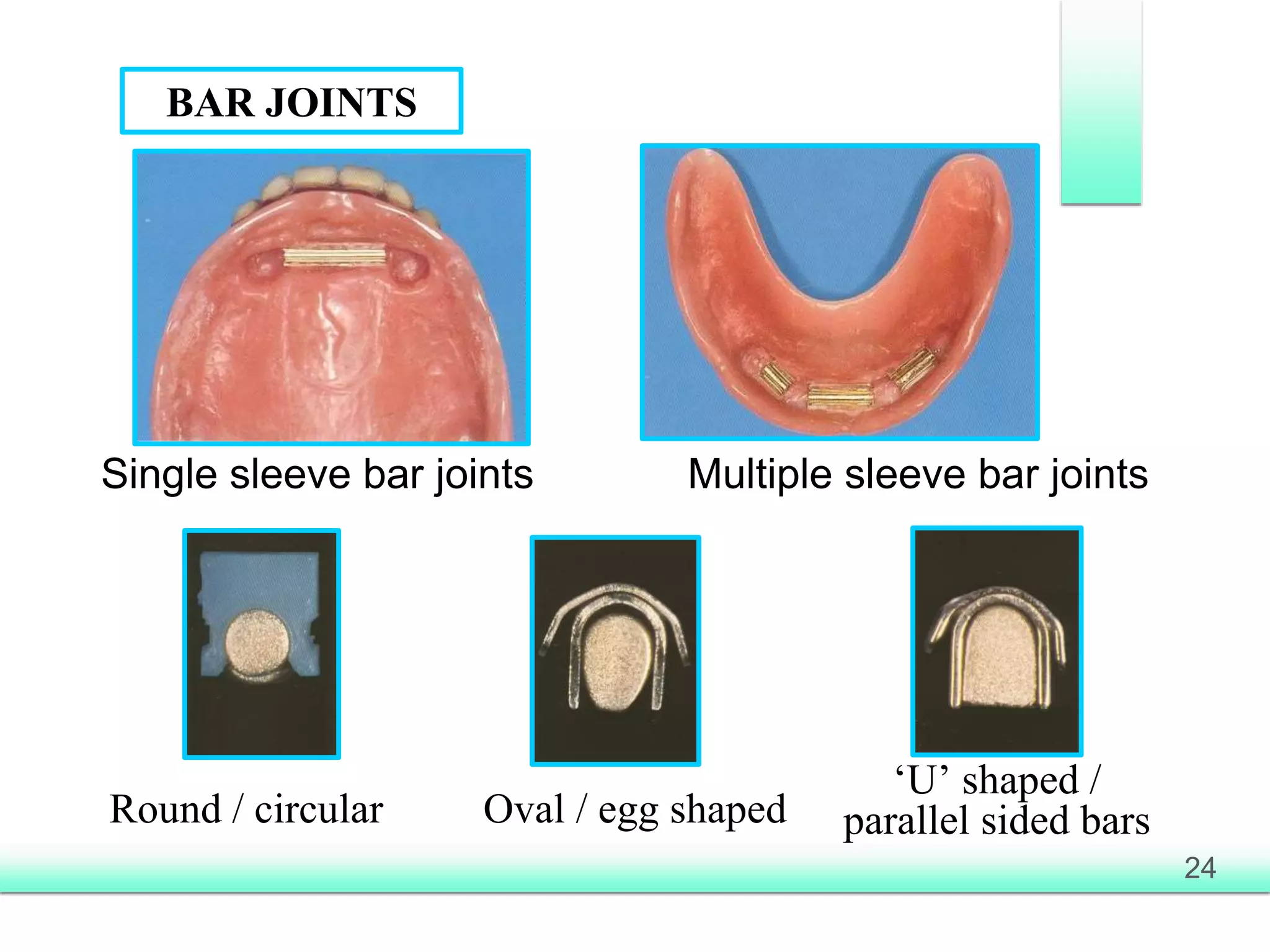 Attachments in removable partial prosthesis | PPTX
