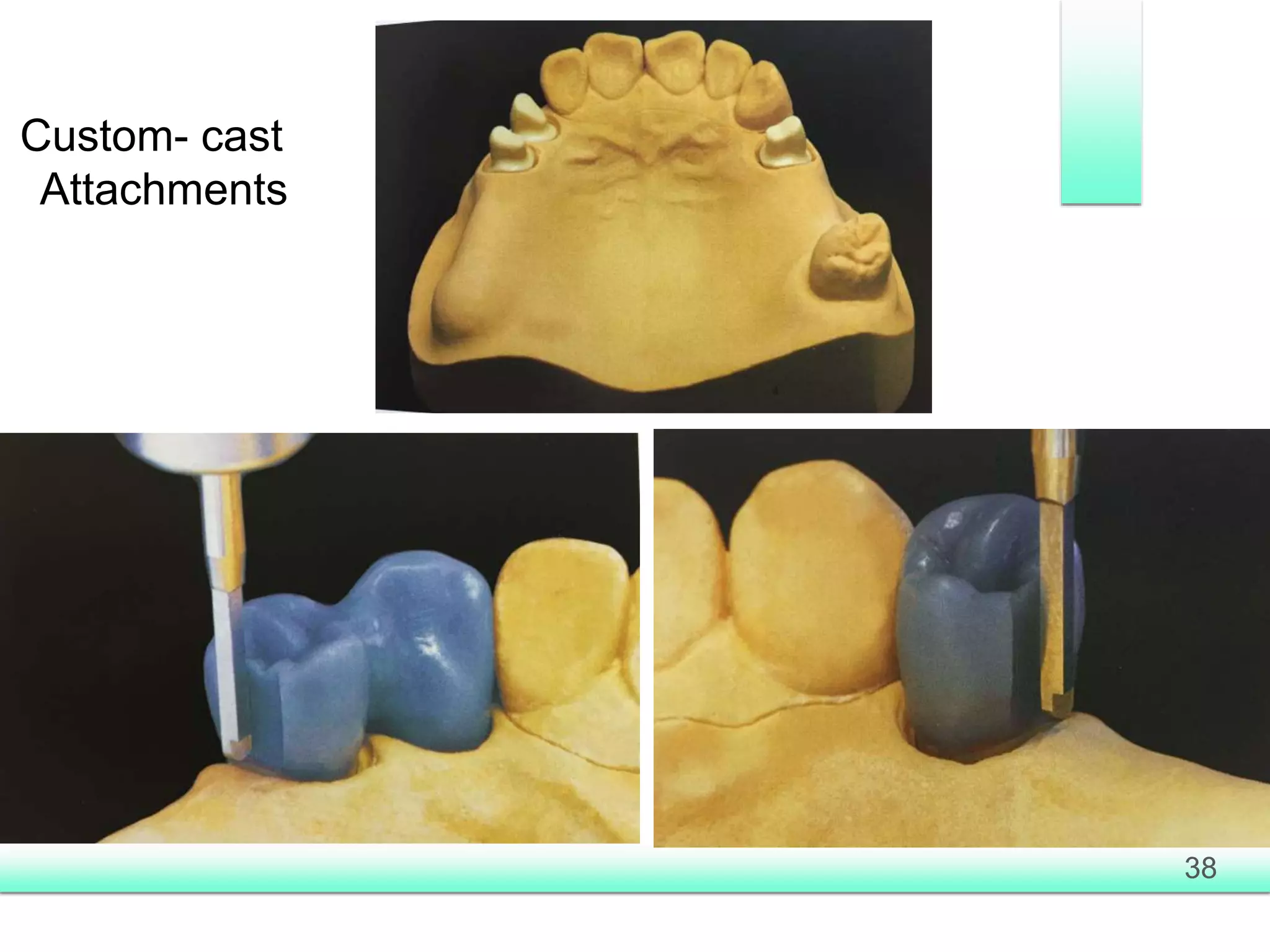 Attachments in removable partial prosthesis | PPTX