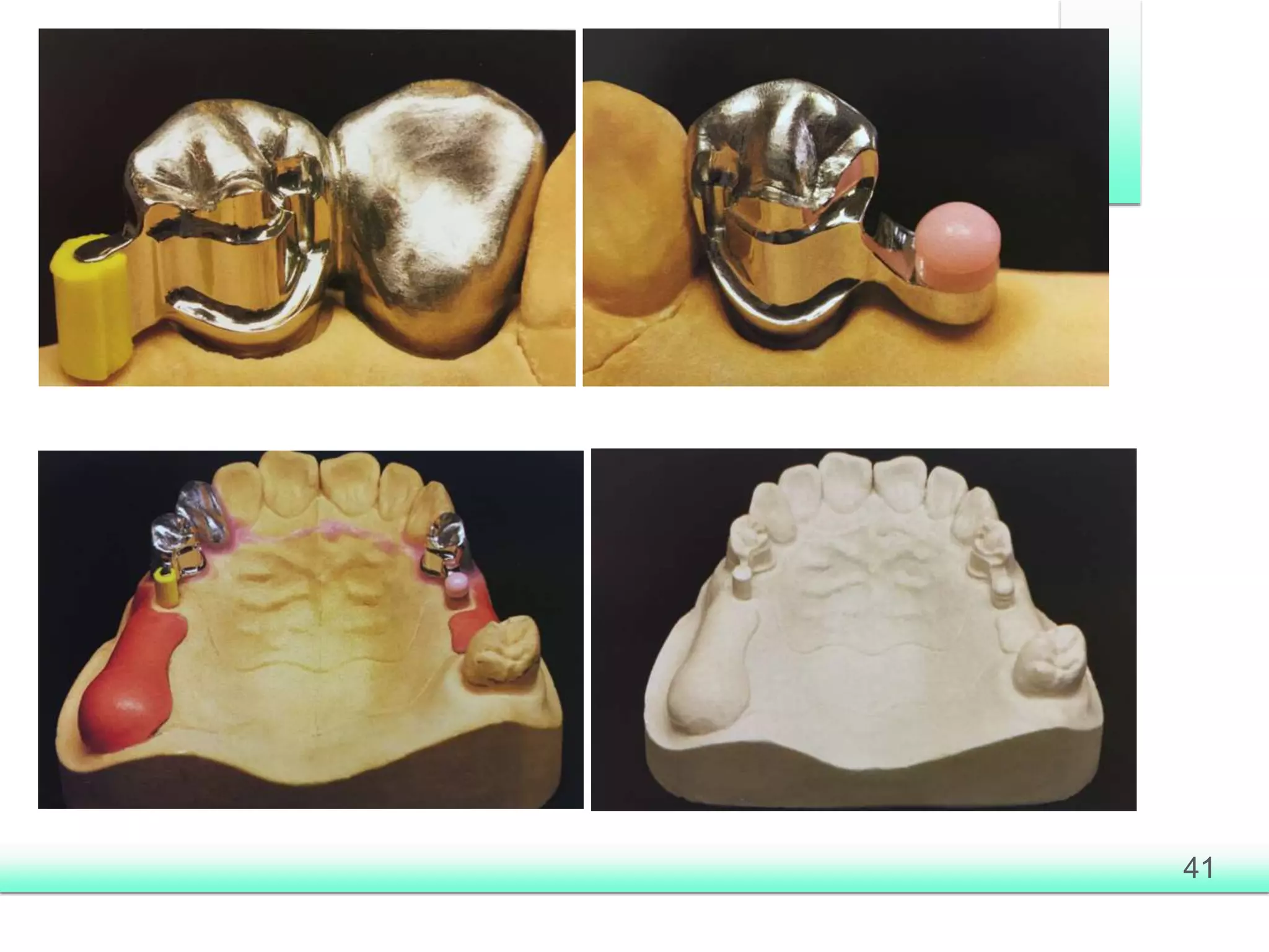 Attachments in removable partial prosthesis | PPTX