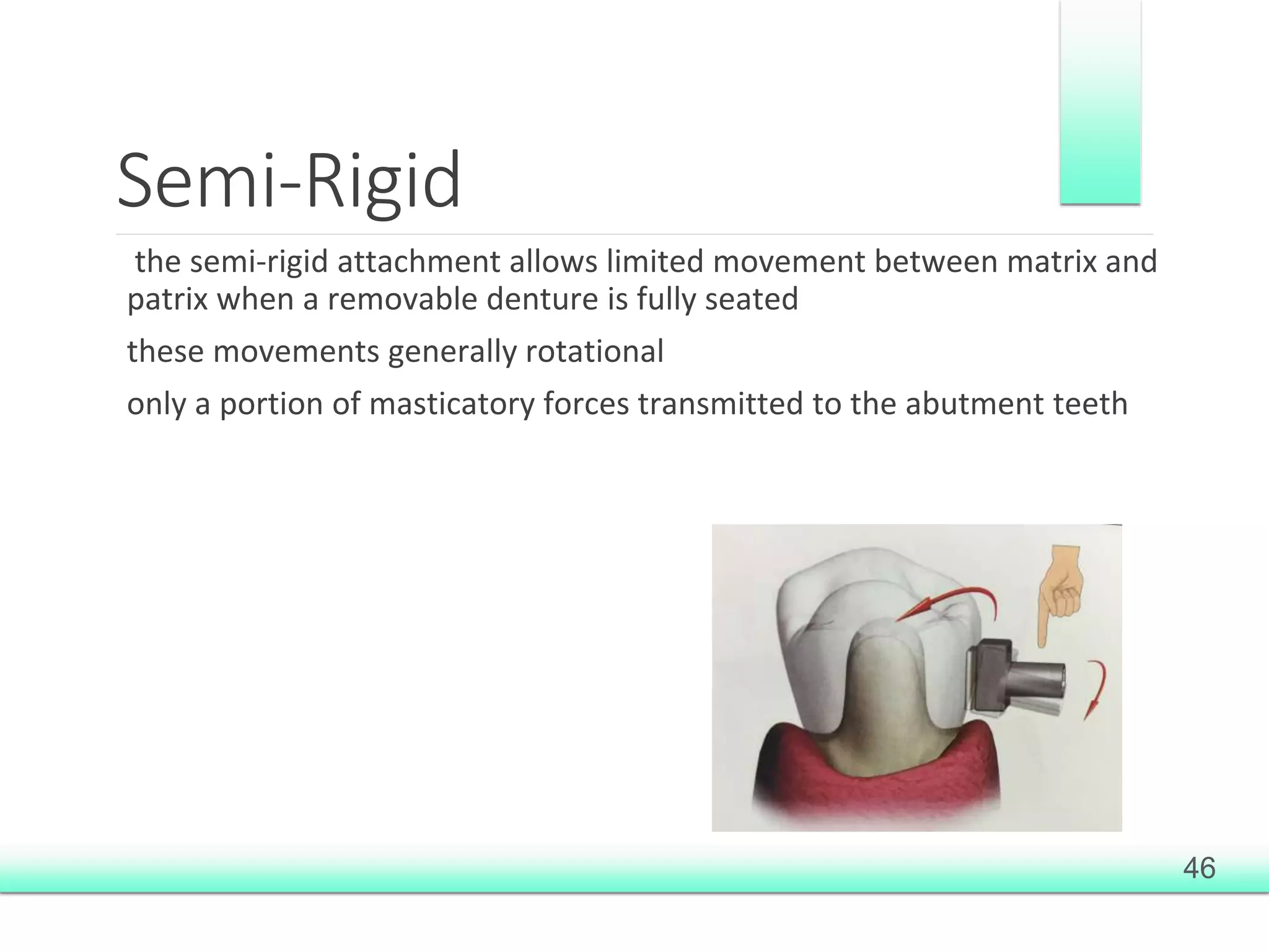 Attachments in removable partial prosthesis | PPTX