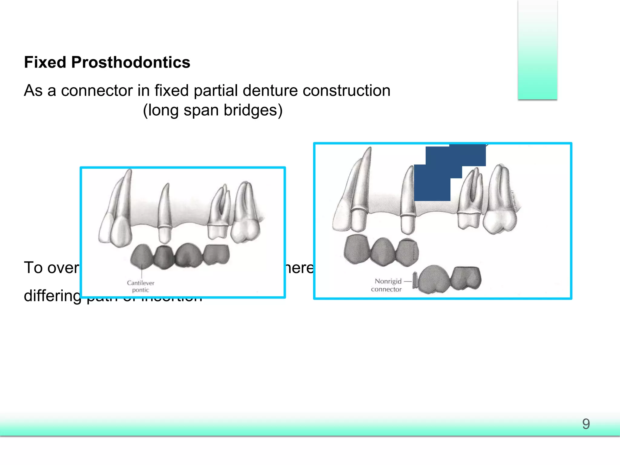 Attachments in removable partial prosthesis | PPTX